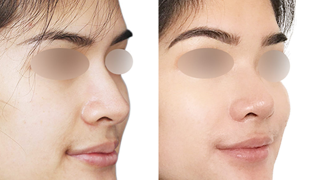 Nose Surgery - Alar Base Reduction + Tip Plasty - JW Plastic Surgery