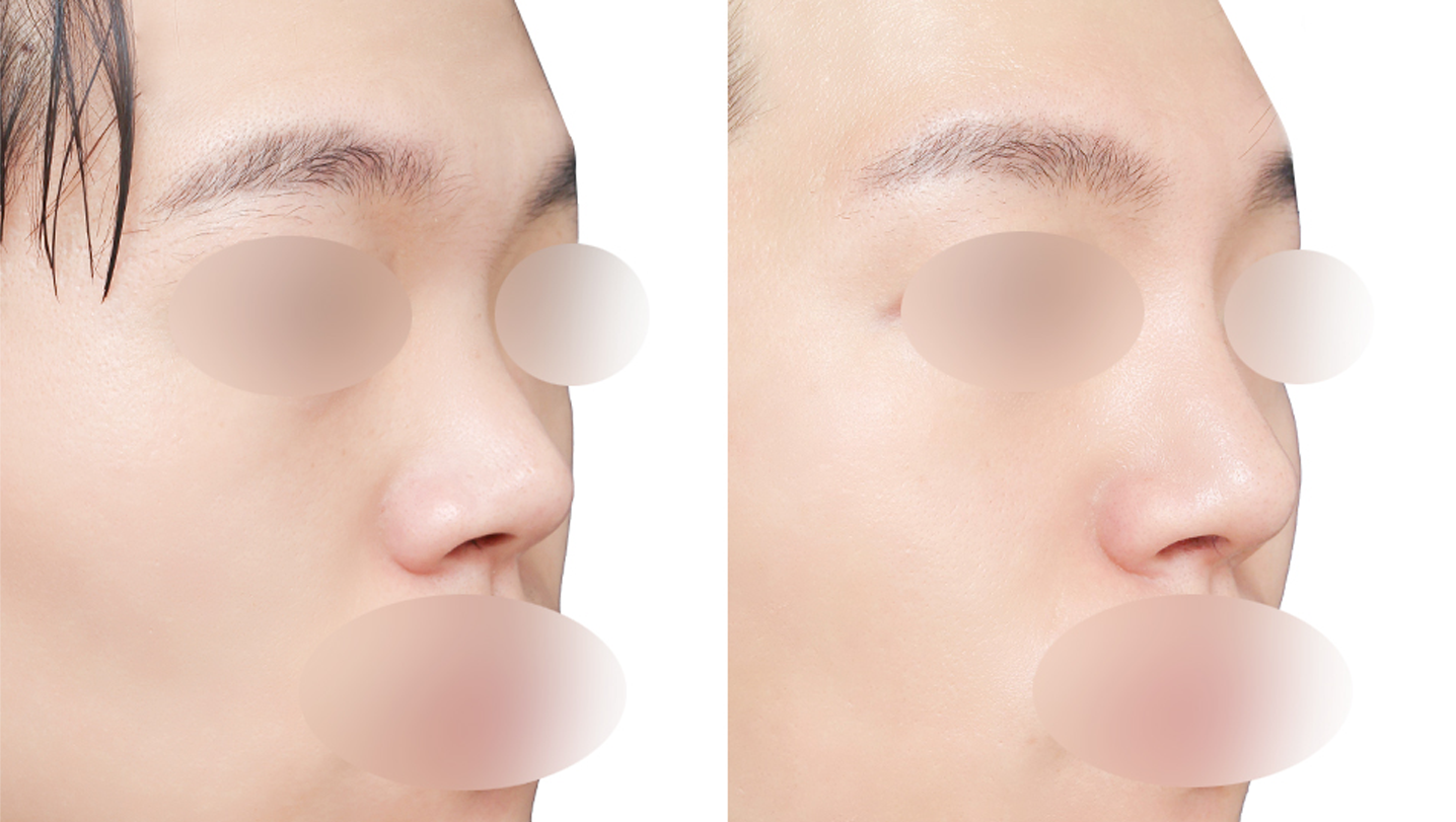 3D Printed INNOFIT Implant Rhinoplasty