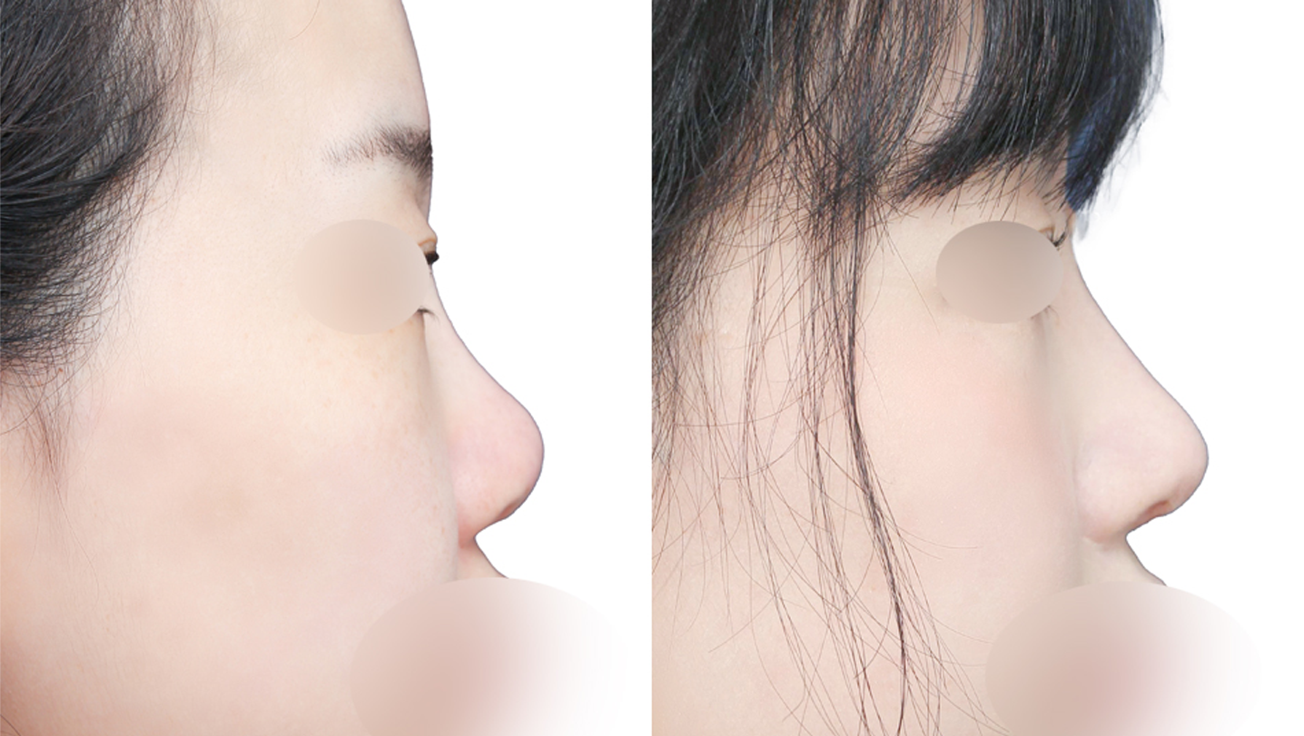 3D Printed INNOFIT Implant Rhinoplasty